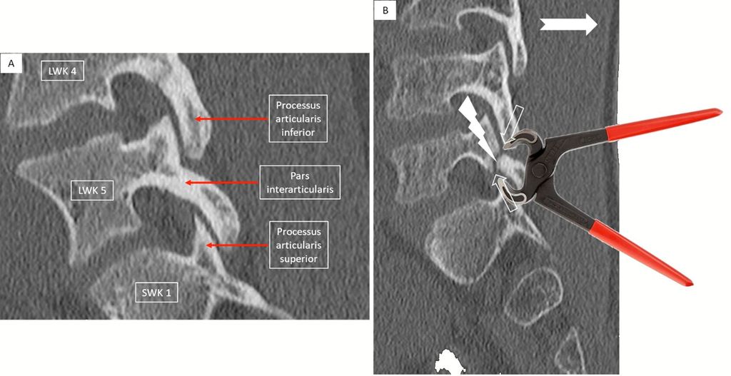 Isthmische Spondylolyse und Spondylo-listhese beKindern und ...