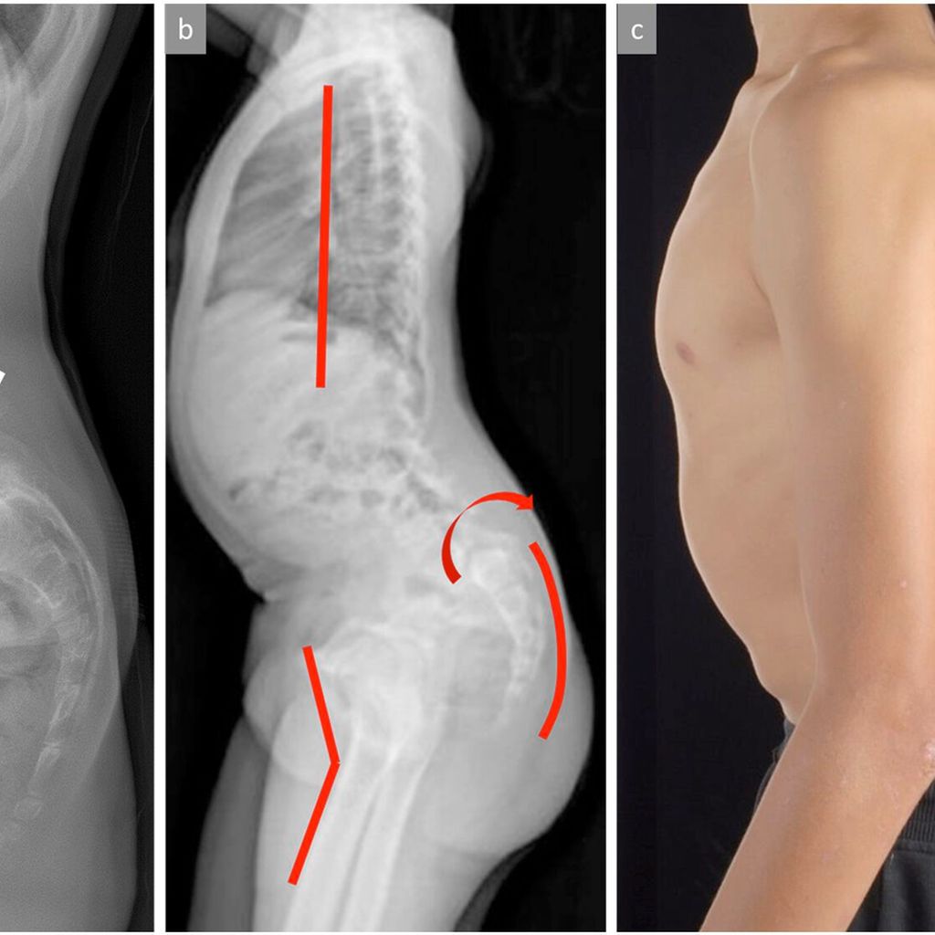 Isthmische Spondylolyse und Spondylo-listhese beKindern und ...