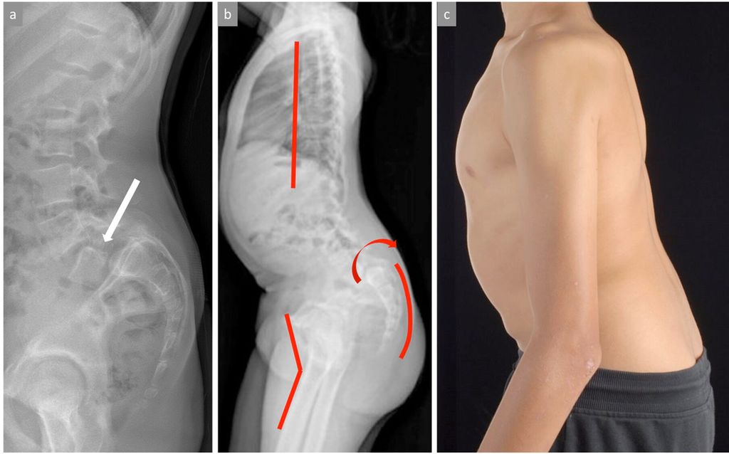 Isthmische Spondylolyse und Spondylo-listhese beKindern und ...